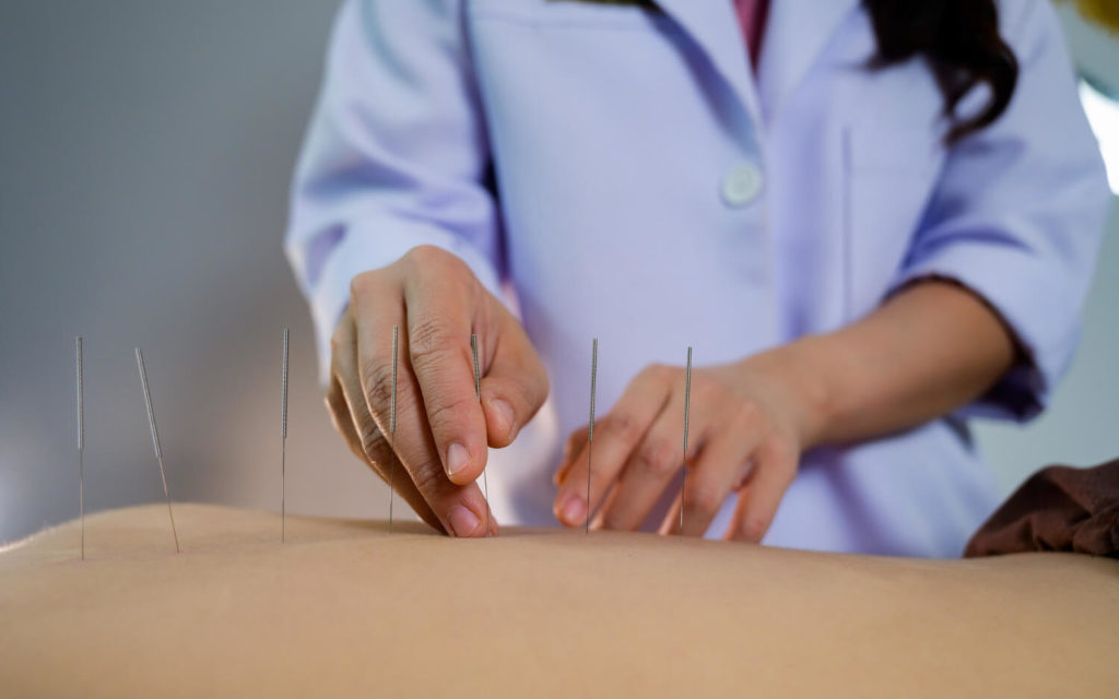 Acupuncture Treatments Brampton: Acupuncture at Home & Clinic Treatments